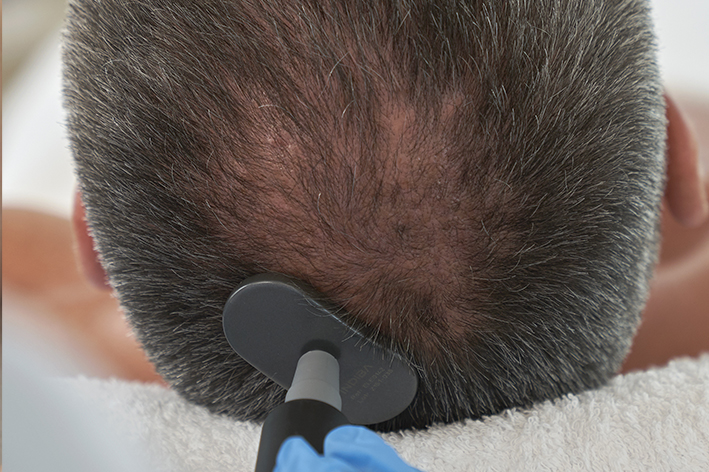 Hair Massage Devices - Indiba Asia